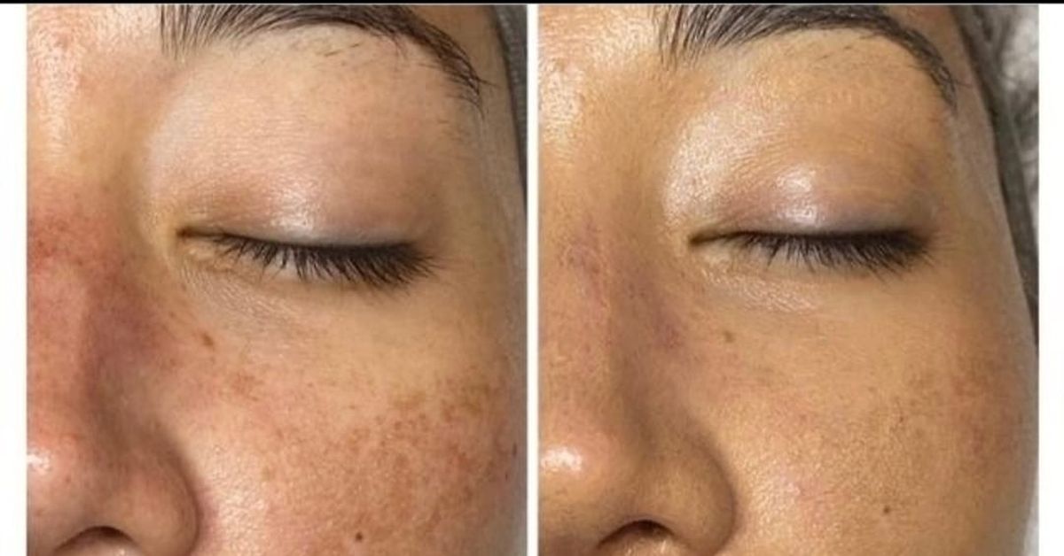 Cosmelan : Le traitement ultime pour éliminer les taches pigmentaires et retrouver un teint éclatant