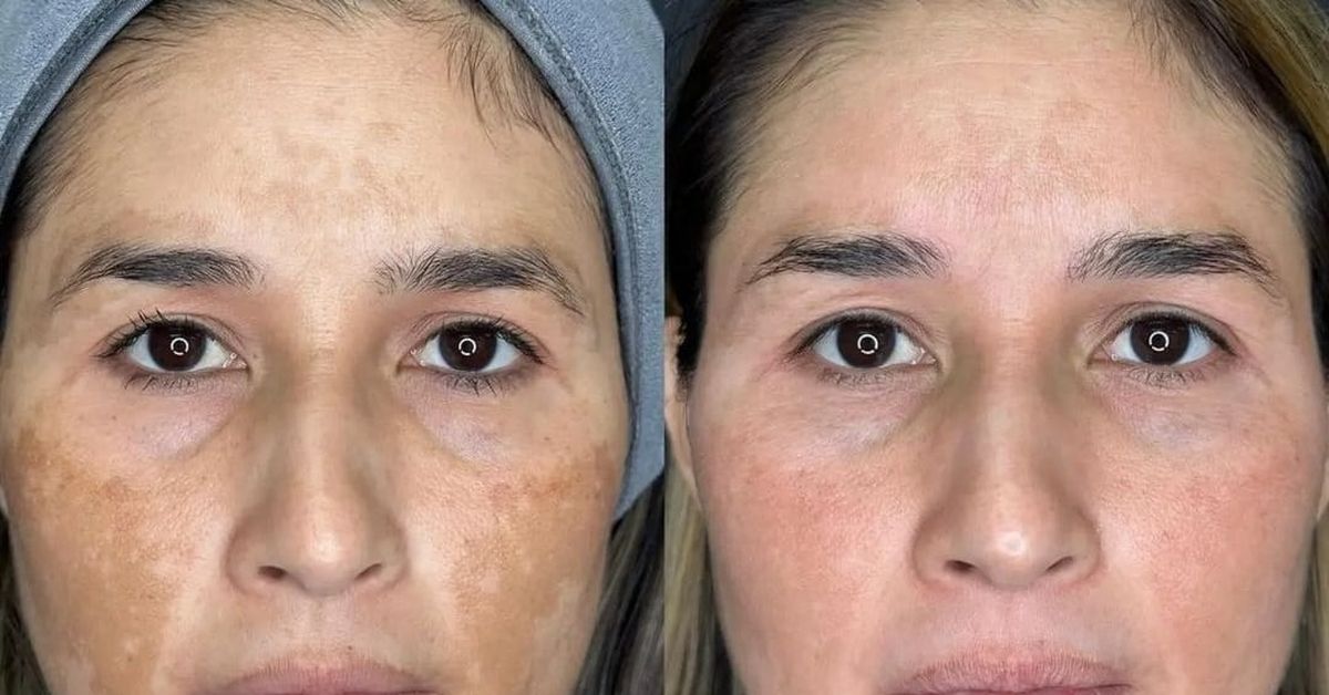 Cosmelan : le traitement miracle pour effacer les taches et retrouver ...