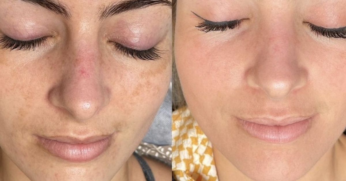 AVANT APRÈS - traitement dépigmentant pour éliminer les taches brunes et unifier le teint à ...